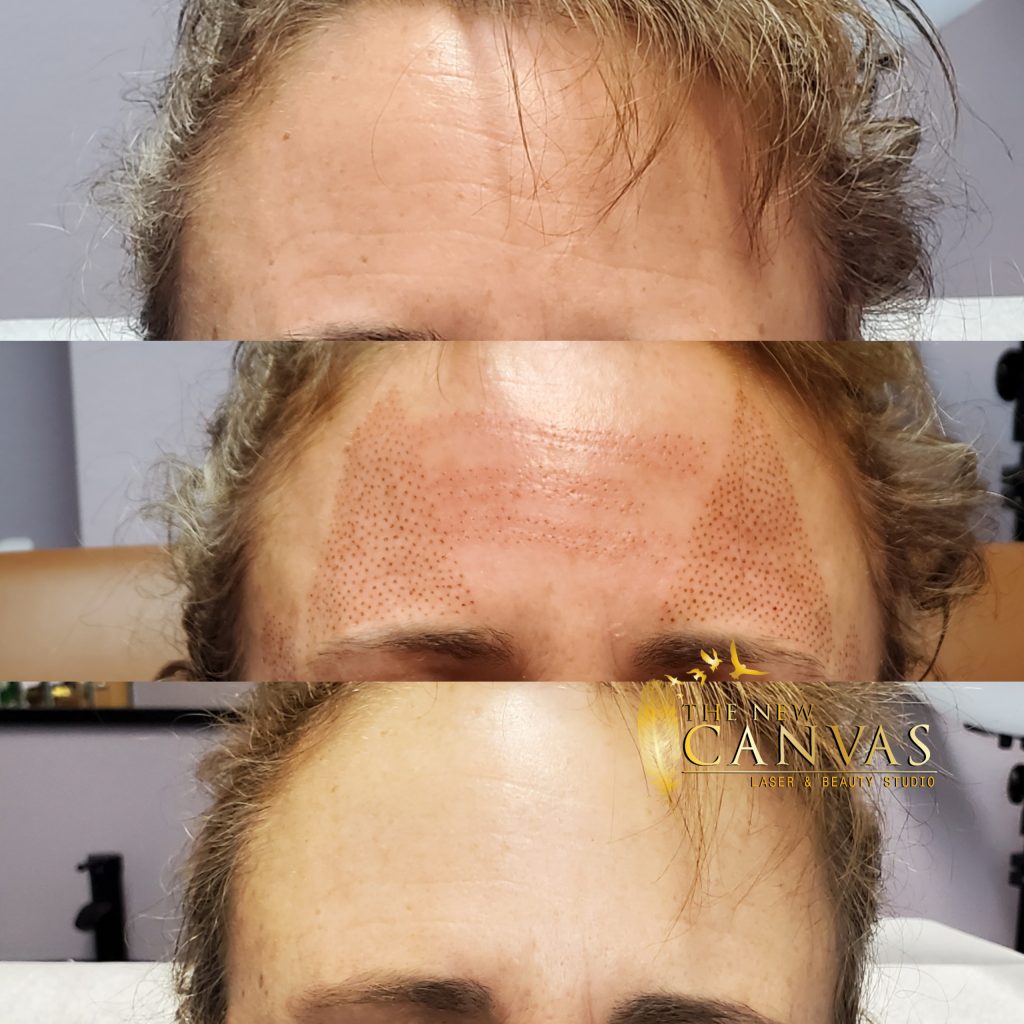 Plasma Fibroblast in Colorado Springs - The New Canvas