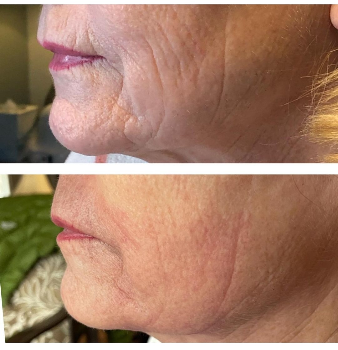 Plasma Fibroblast in Colorado Springs - The New Canvas