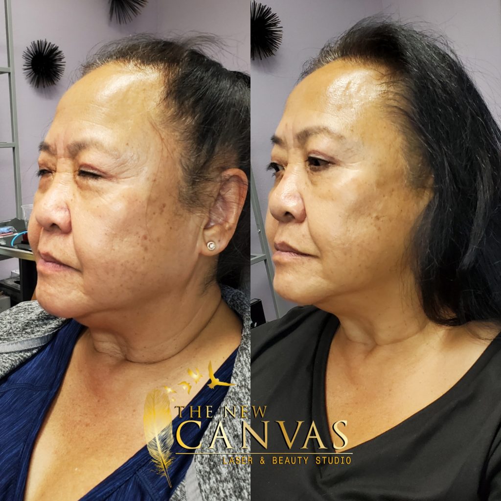 High Intensity Focused Ultrasound – The New Canvas